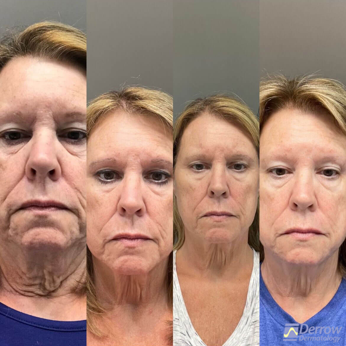 Look Book (Before & After) - Derrow Dermatology